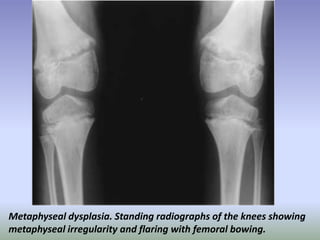 Presentation1.pptx, radiological imaging of skeletal dysplasia | PPTX