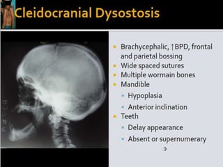 Cleidocranial Dysplasia Radiology