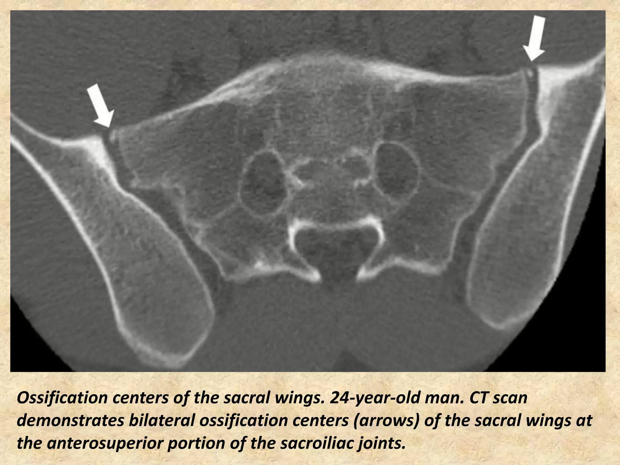 Presentation1.pptx, radiological imaging of sacroiliac joint diseases ...
