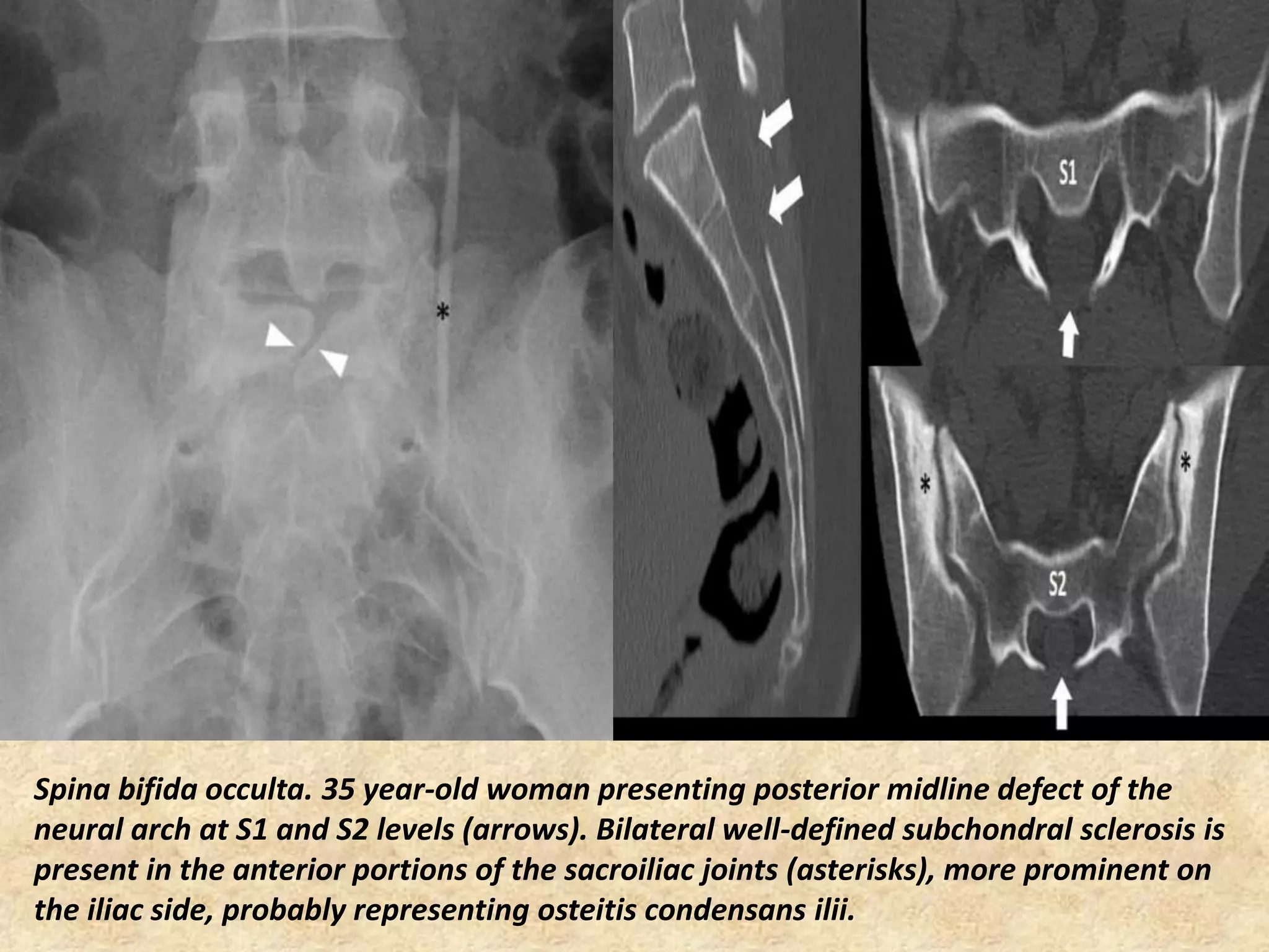 Presentation1.pptx, radiological imaging of sacroiliac joint diseases ...