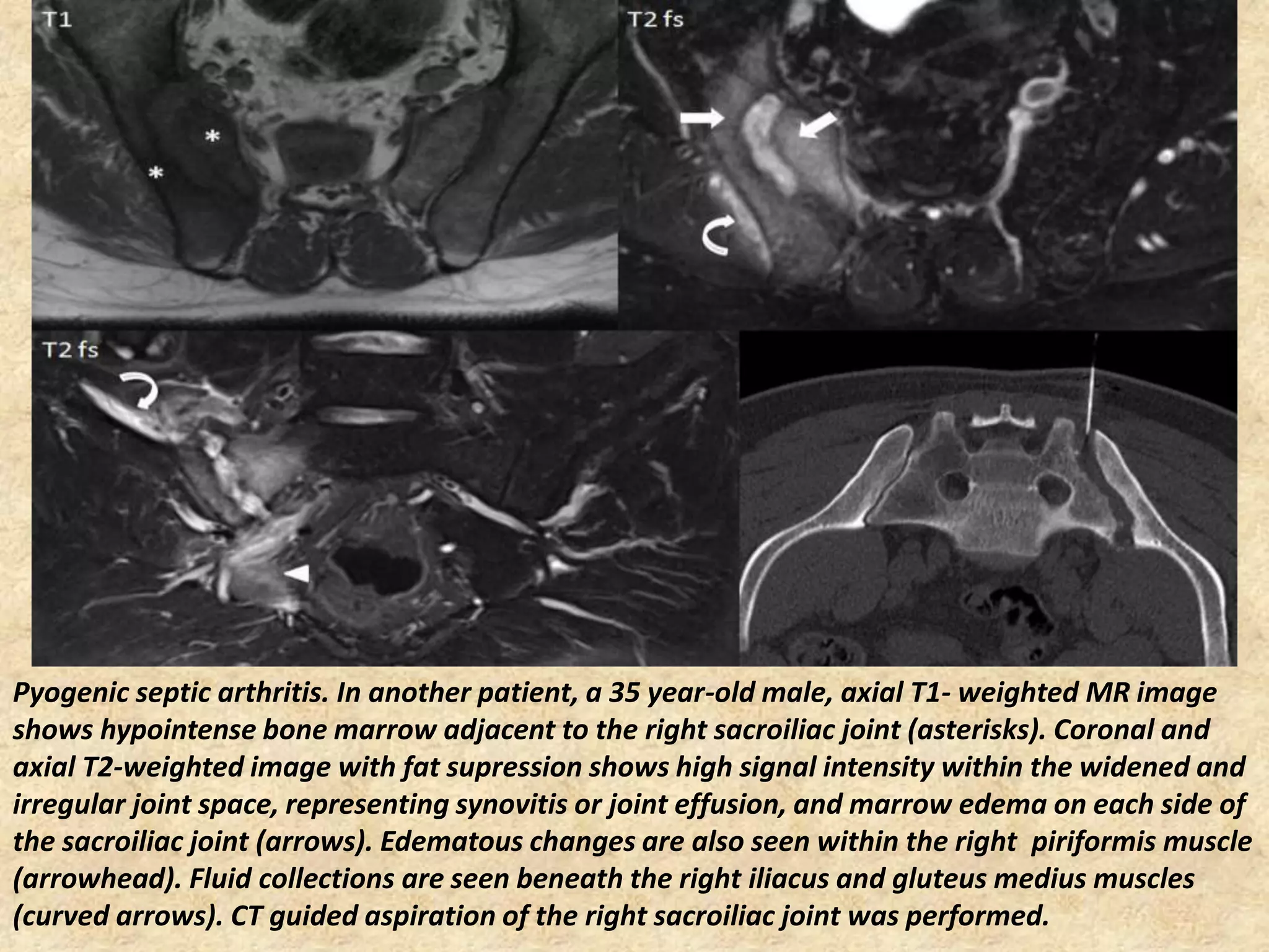 Presentation1.pptx, radiological imaging of sacroiliac joint diseases ...