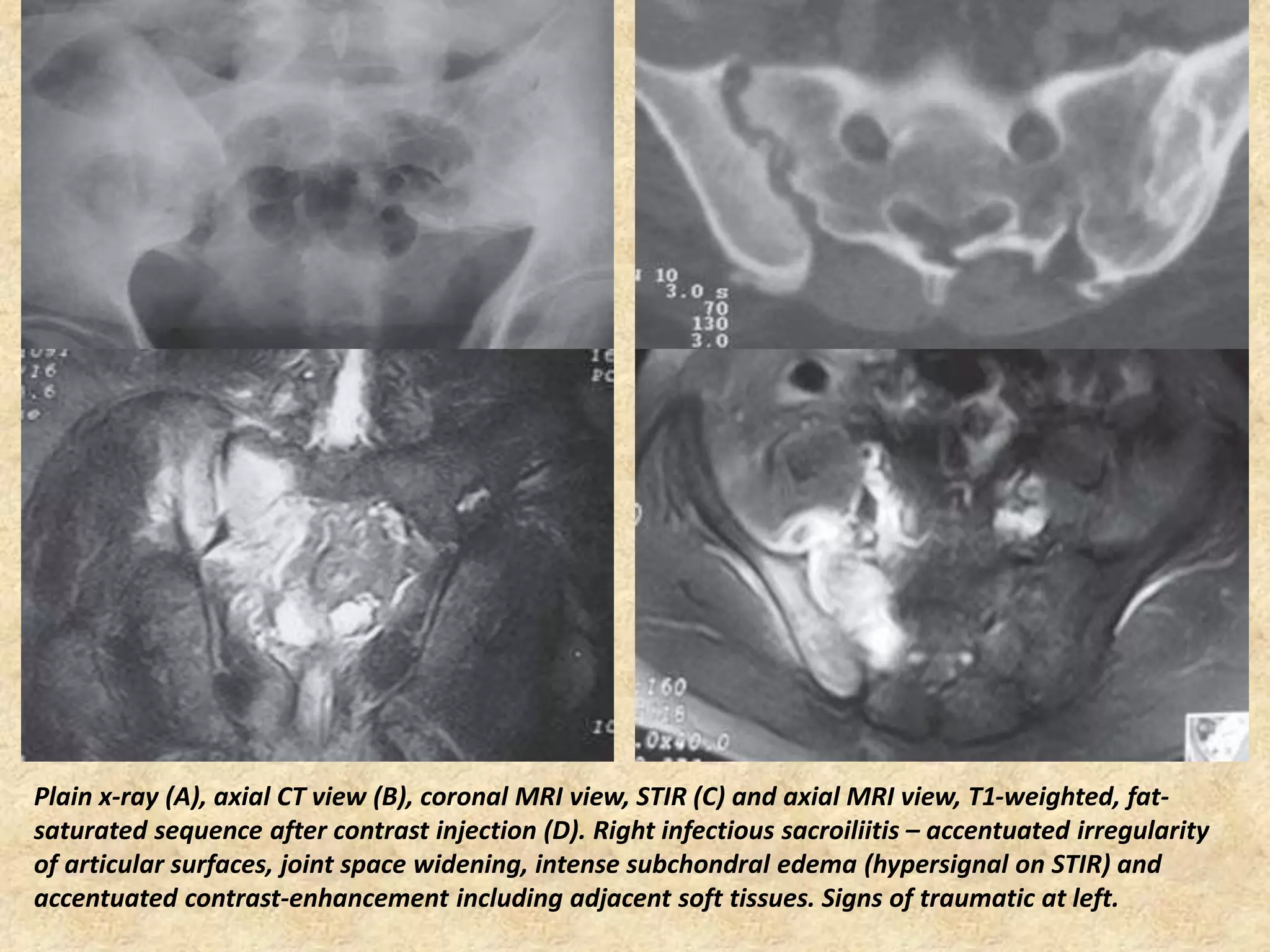 Presentation1.pptx, radiological imaging of sacroiliac joint diseases ...