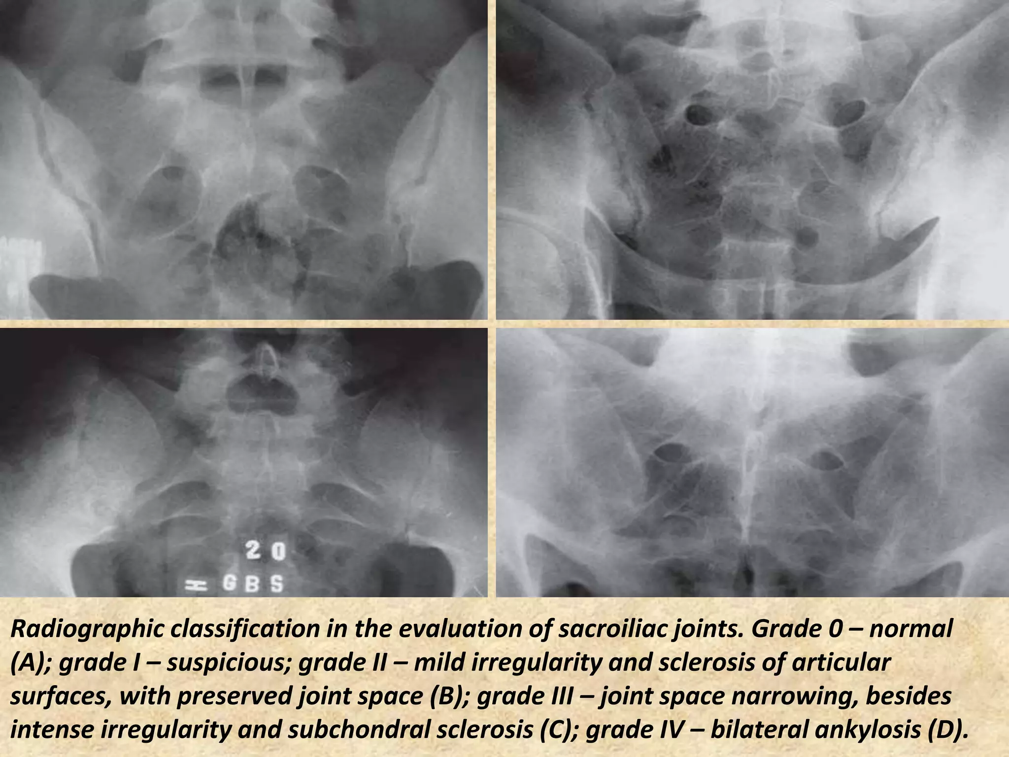 Presentation1.pptx, radiological imaging of sacroiliac joint diseases ...