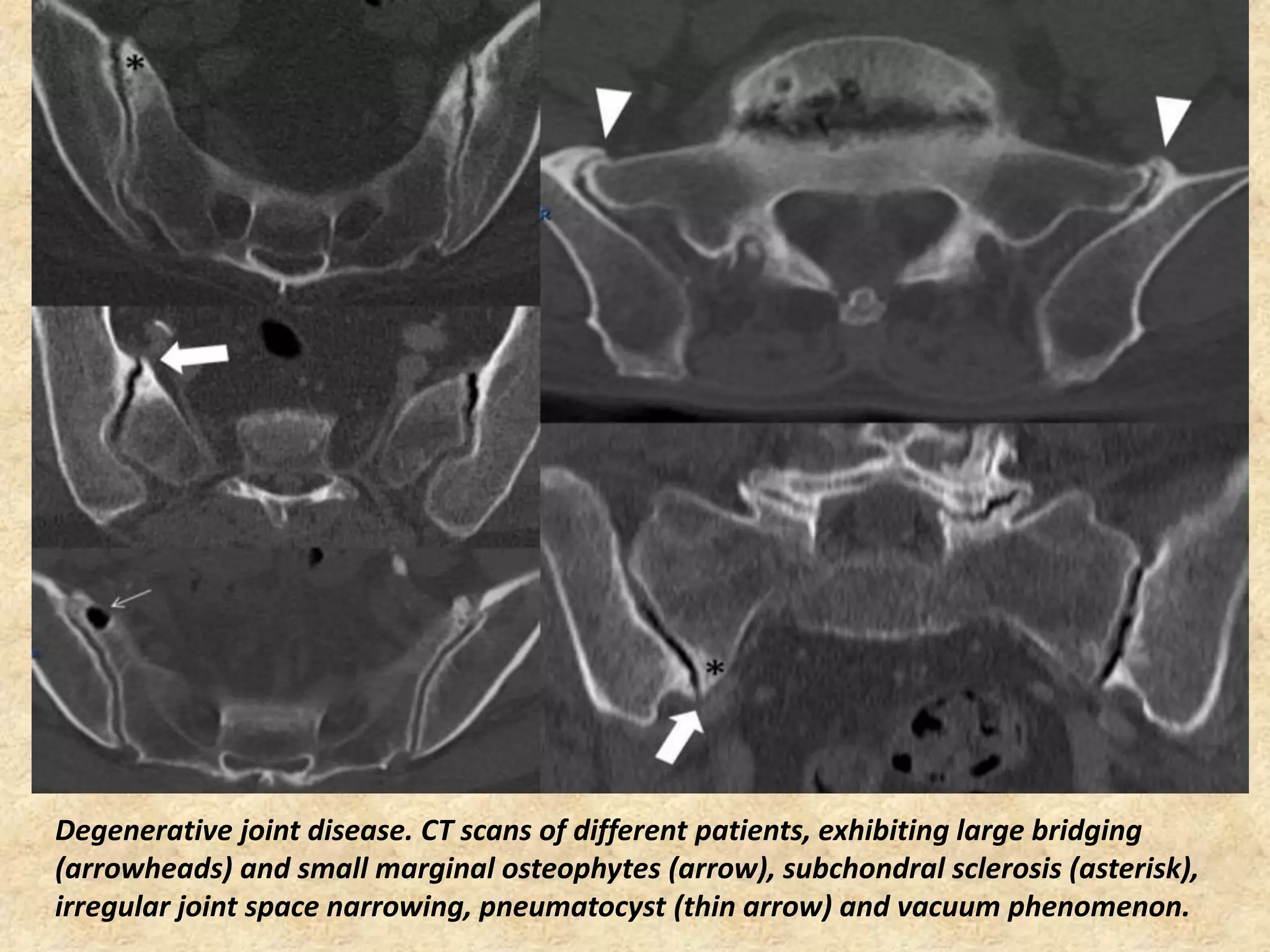Presentation1.pptx, radiological imaging of sacroiliac joint diseases ...