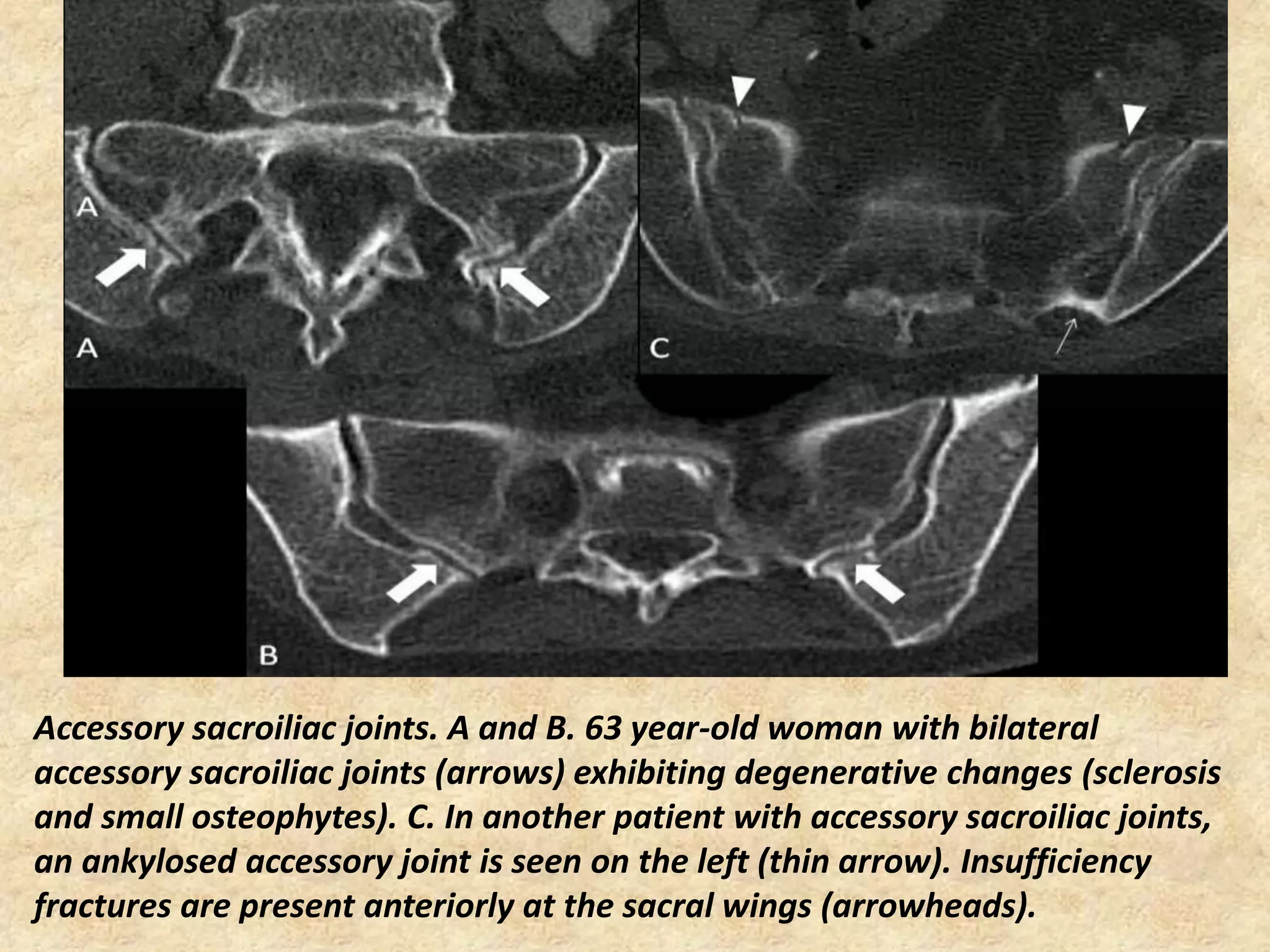 Presentation1.pptx, radiological imaging of sacroiliac joint diseases ...