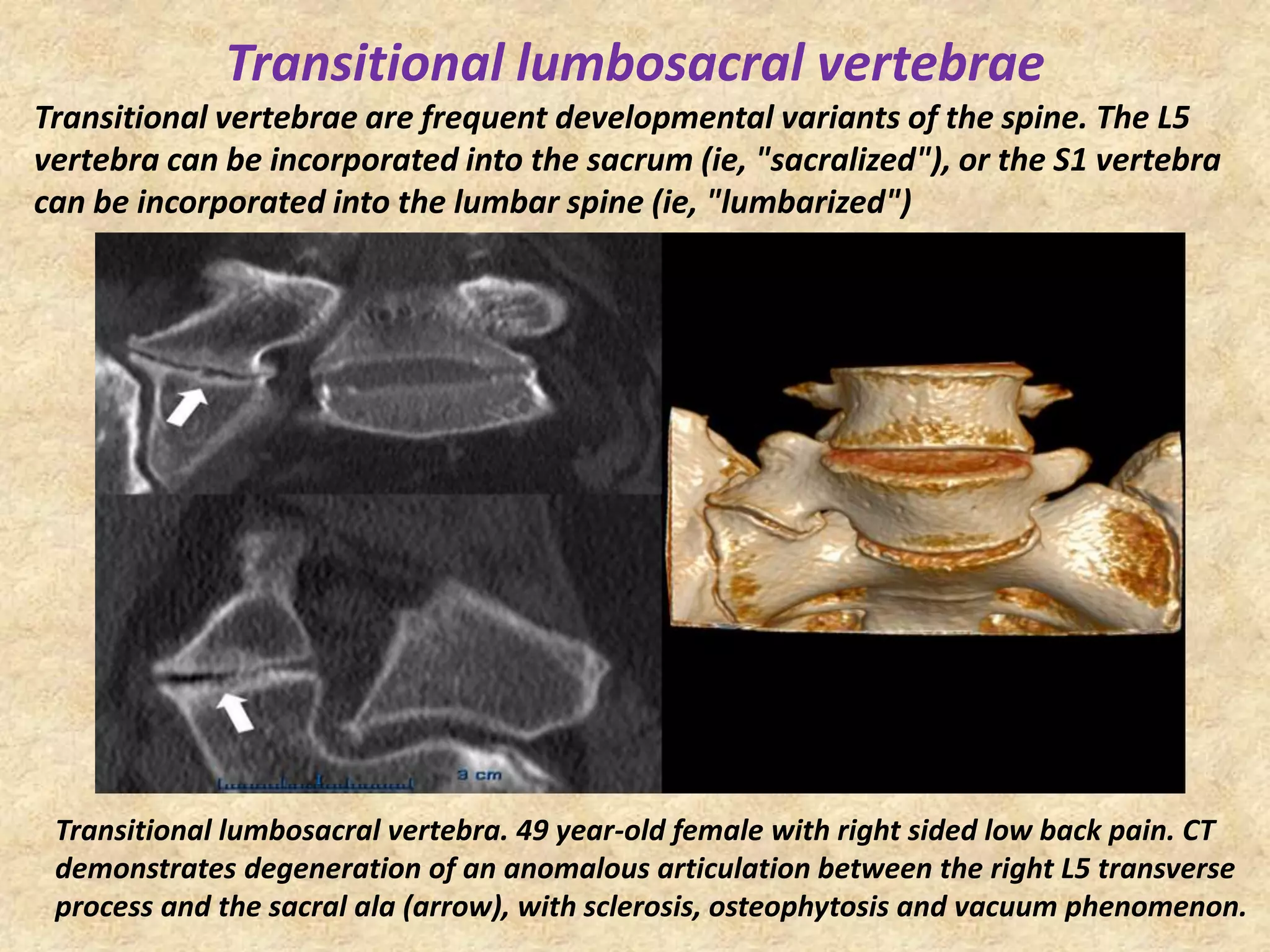 Presentation1.pptx, radiological imaging of sacroiliac joint diseases ...