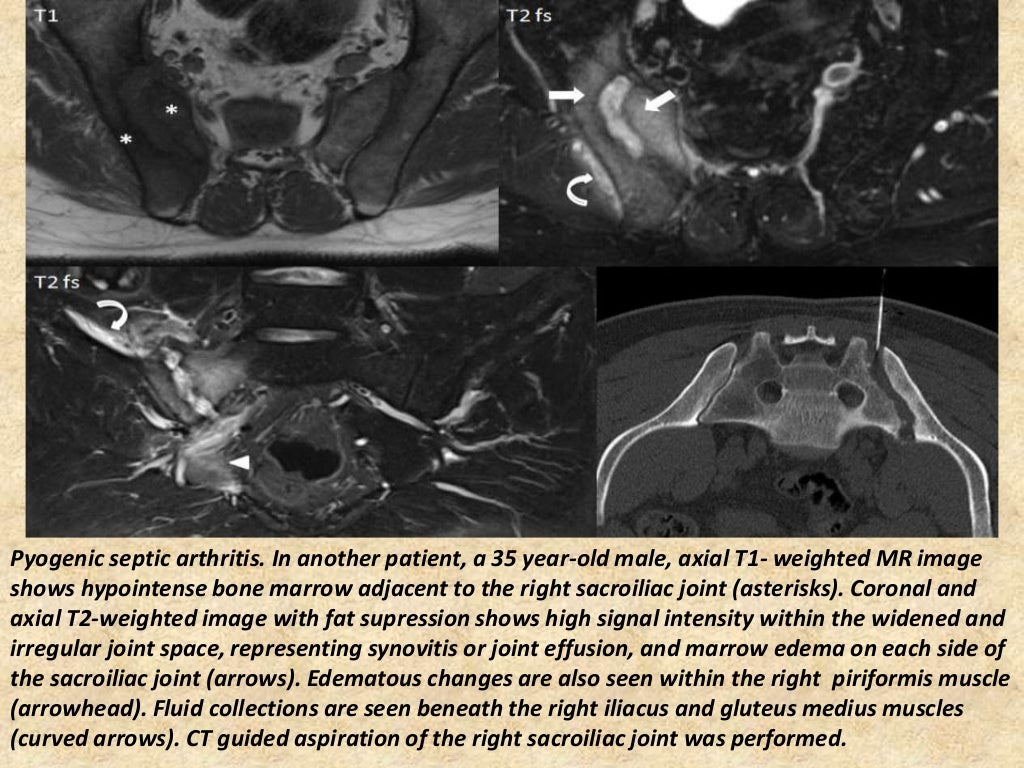 Sacroiliac Joint Cancer – Management of metastatic sacral tumours – VRIMCA