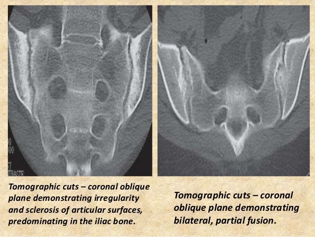 Presentation1.pptx, radiological imaging of sacroiliac joint diseases.