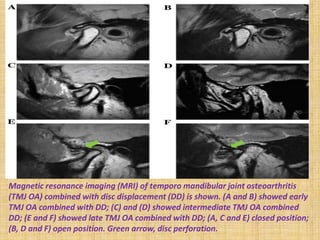 Presentation1.pptx, radiological imaging of temporo mandibular joint ...