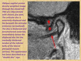 Presentation1.pptx, radiological imaging of temporo mandibular joint ...