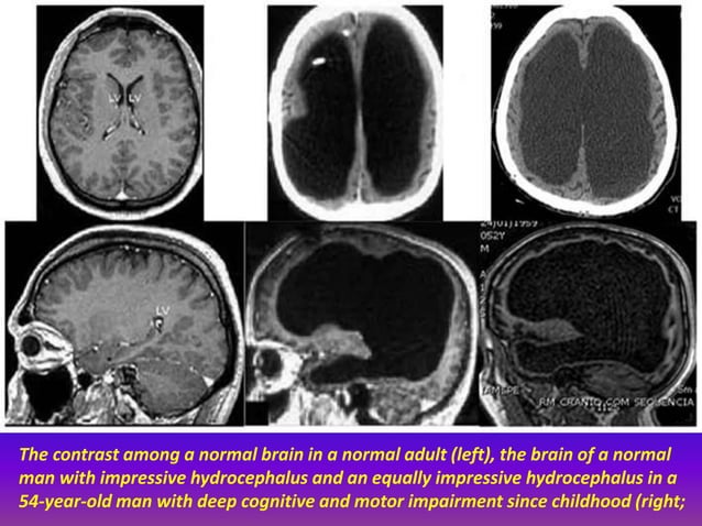 Presentation1.pptx, radiological imaging of hydrocephalus. | PPTX