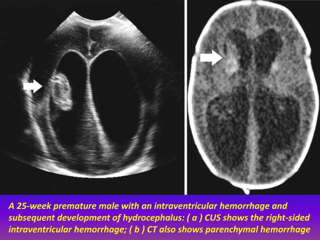 Presentation1.pptx, radiological imaging of hydrocephalus. | PPTX
