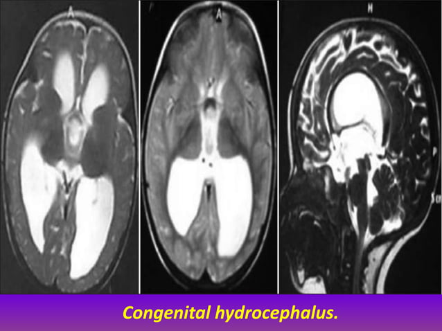 Presentation1.pptx, radiological imaging of hydrocephalus. | PPTX