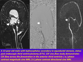 Presentation1.pptx, radiological imaging of hydrocephalus. | PPTX