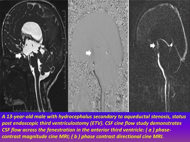 Presentation1.pptx, radiological imaging of hydrocephalus. | PPTX