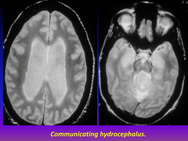 Presentation1.pptx, radiological imaging of hydrocephalus. | PPTX