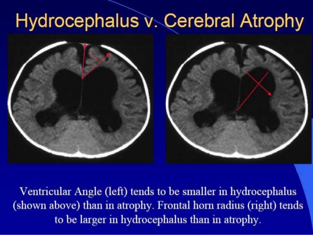 Presentation1.pptx, radiological imaging of hydrocephalus.