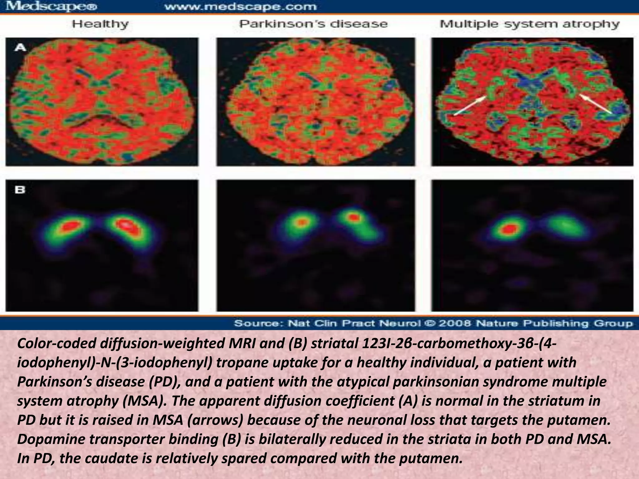 Presentation1.pptx, radiological imaging of parkinsonism. | PPTX