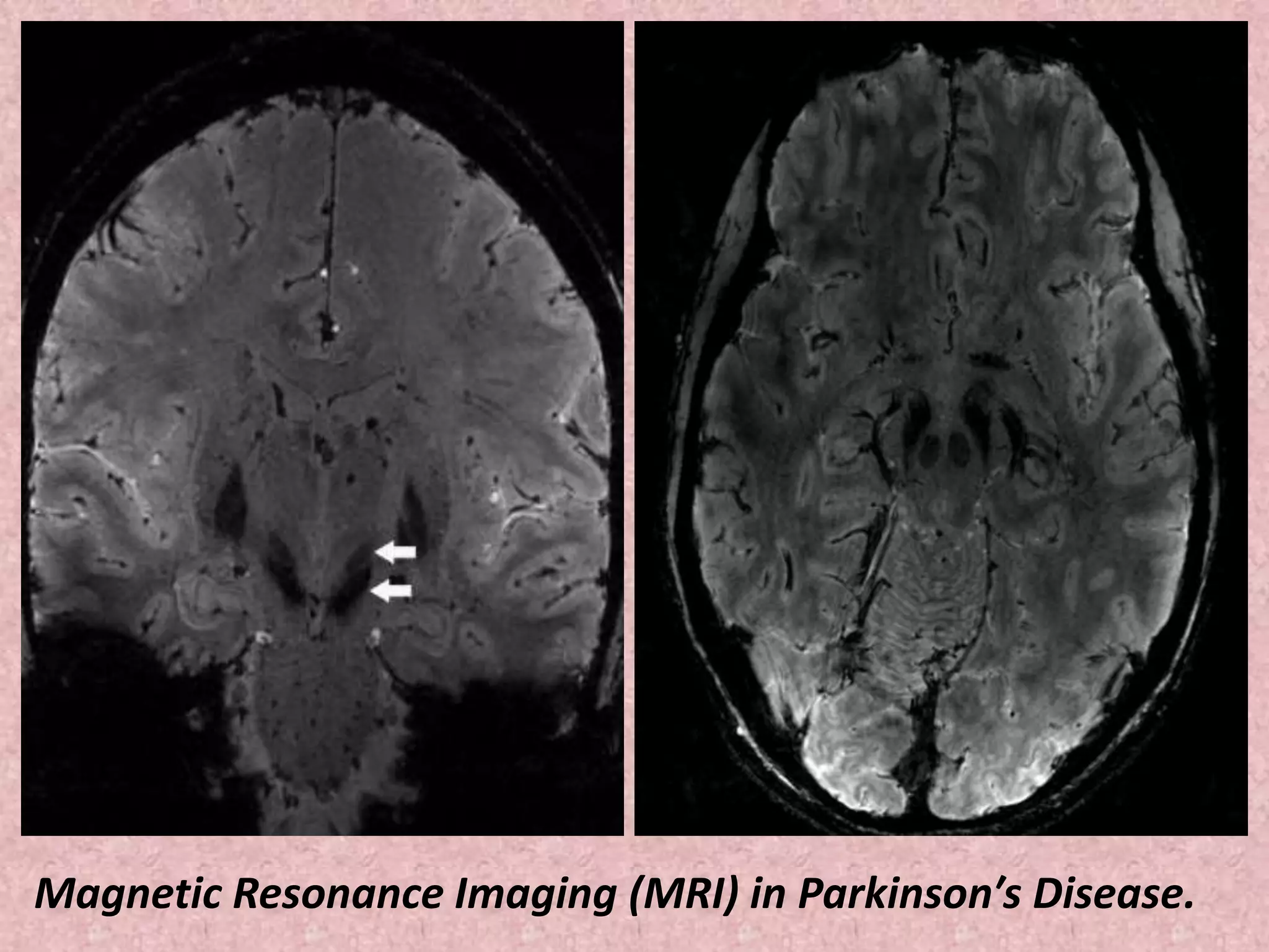 Presentation1.pptx, radiological imaging of parkinsonism. | PPTX