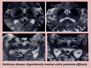 Presentation1.pptx, radiological imaging of parkinsonism. | PPTX