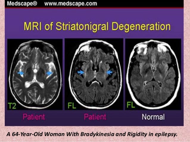 Presentation1.pptx, radiological imaging of parkinsonism.