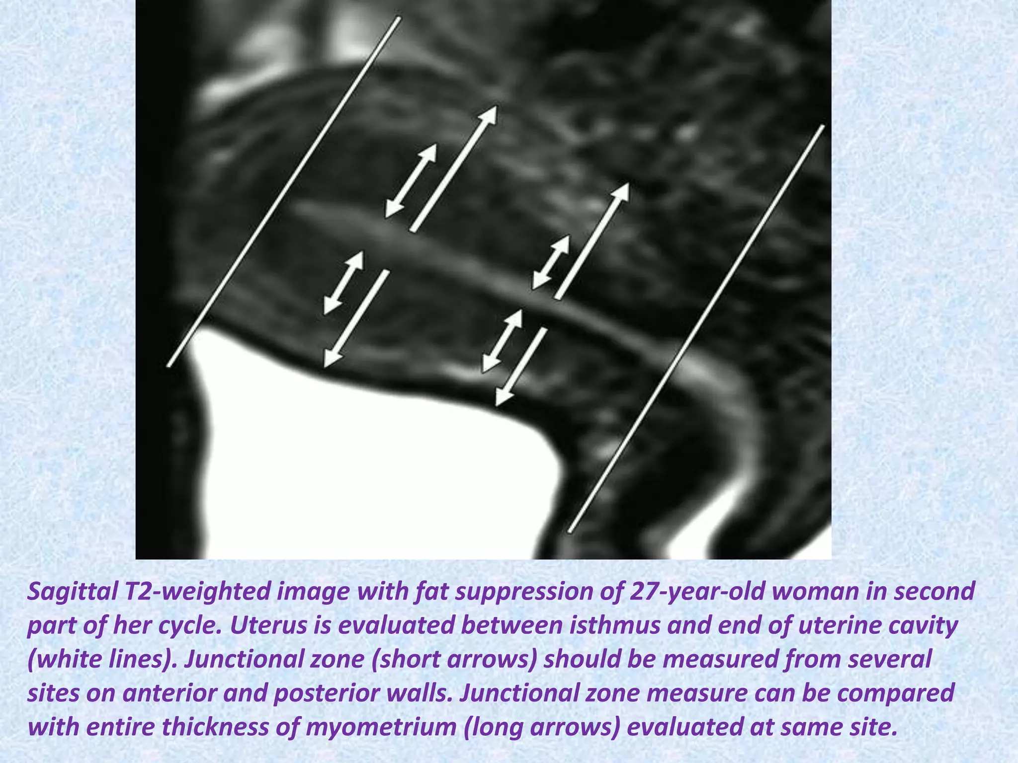 Presentation1.pptx, radiological imaging of endometriosis. | PPTX