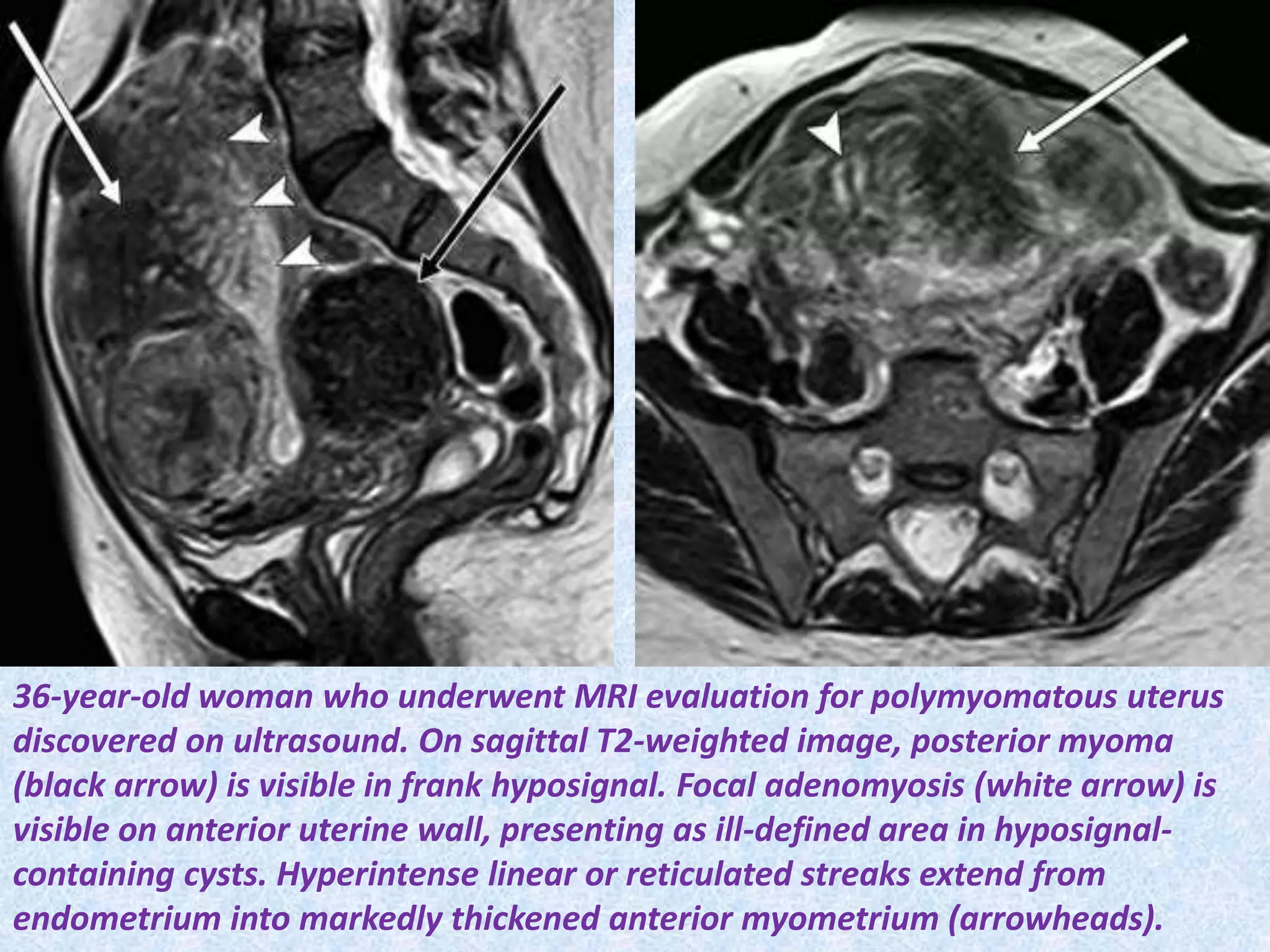 Presentation1.pptx, radiological imaging of endometriosis. | PPTX