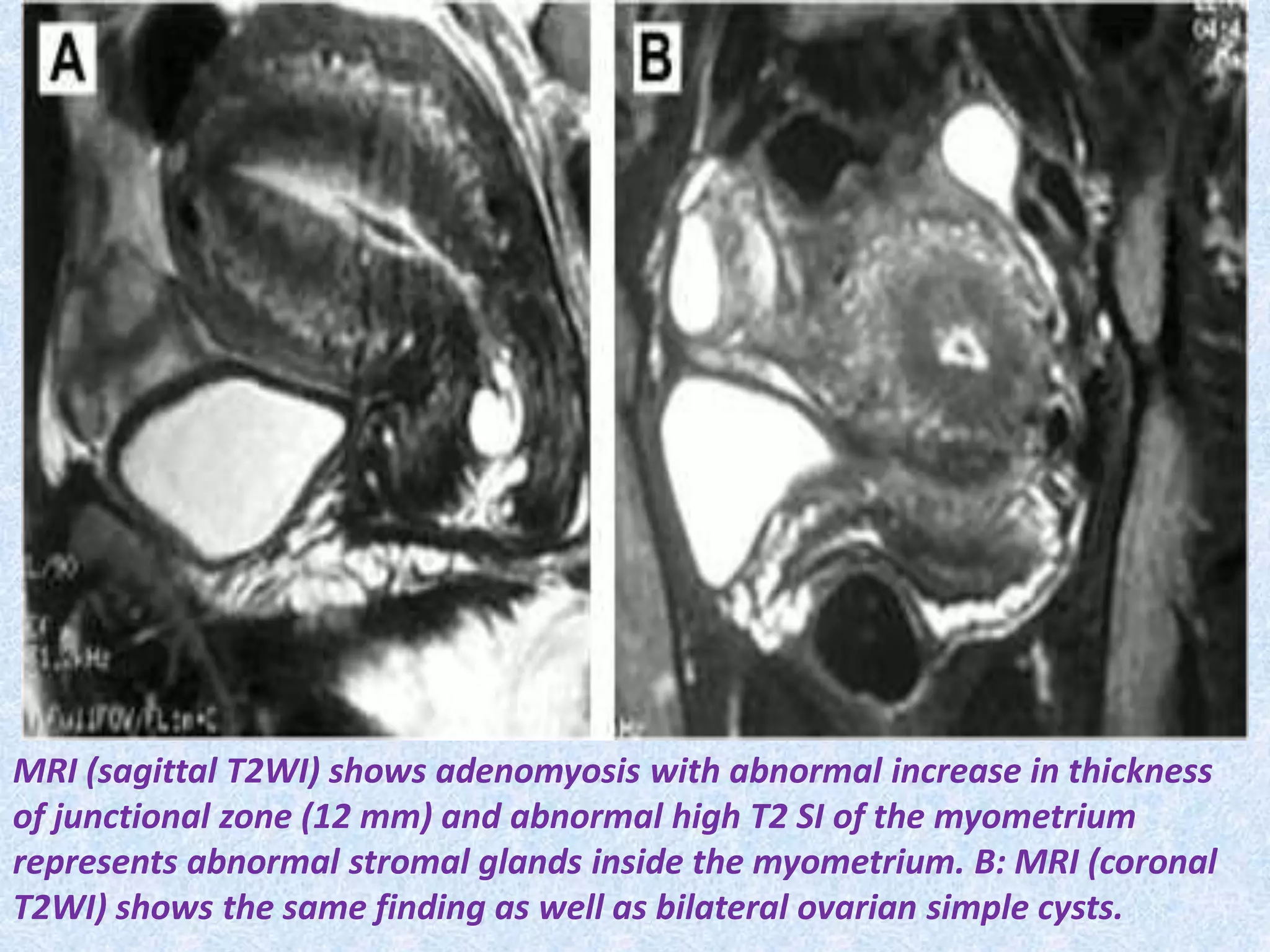 Presentation1.pptx, radiological imaging of endometriosis. | PPTX