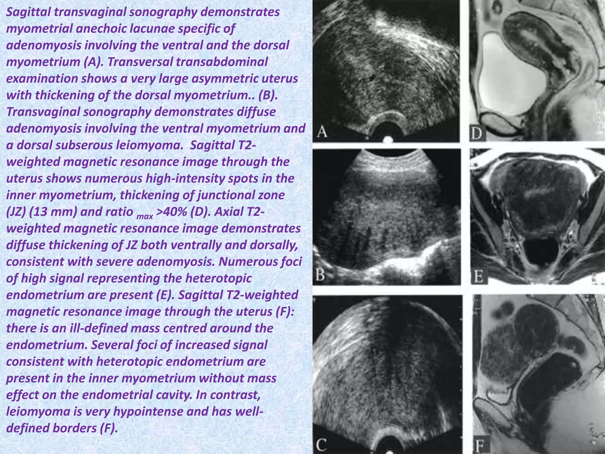 Presentation1.pptx, radiological imaging of endometriosis. | PPTX