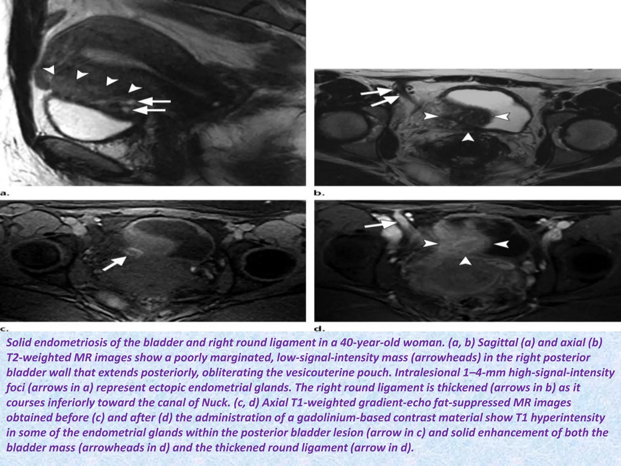 Presentation1.pptx, radiological imaging of endometriosis. | PPTX