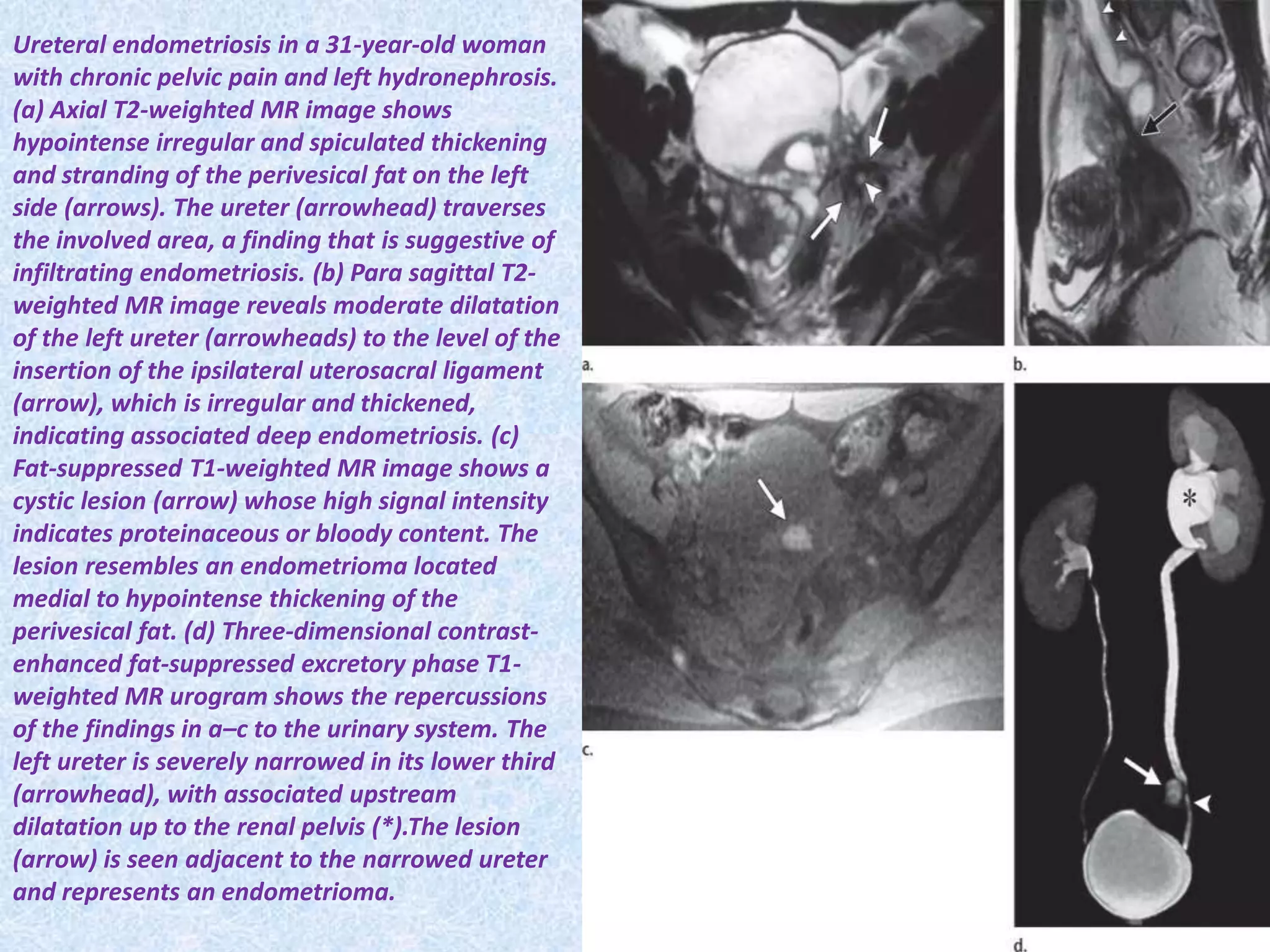Presentation1.pptx, radiological imaging of endometriosis. | PPTX