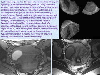 Presentation1.pptx, radiological imaging of endometriosis. | PPTX