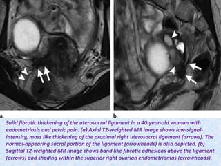 Presentation1.pptx, radiological imaging of endometriosis. | PPTX