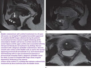 Presentation1.pptx, radiological imaging of endometriosis. | PPTX