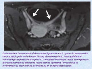 Presentation1.pptx, radiological imaging of endometriosis. | PPTX