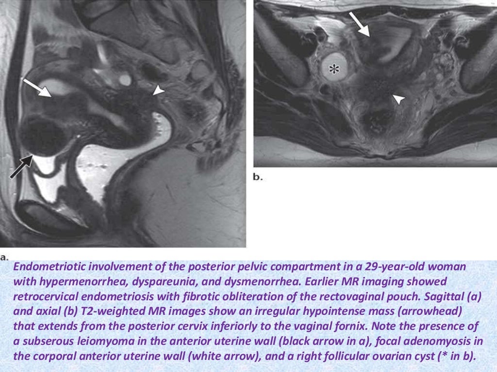 Presentation1.pptx, radiological imaging of endometriosis.