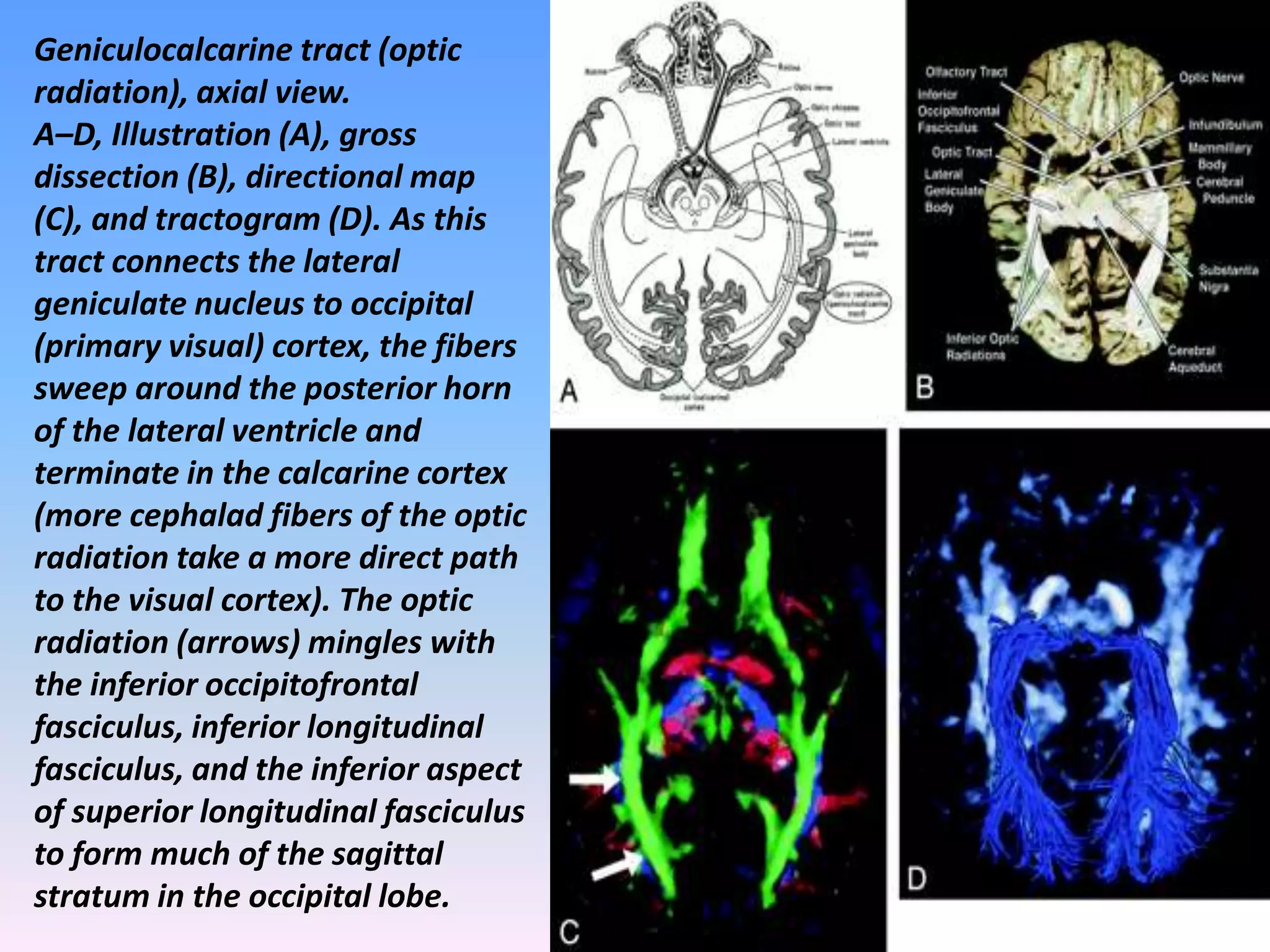 Presentation1.pptx, diffusion tensor imaging of white matter tract in ...