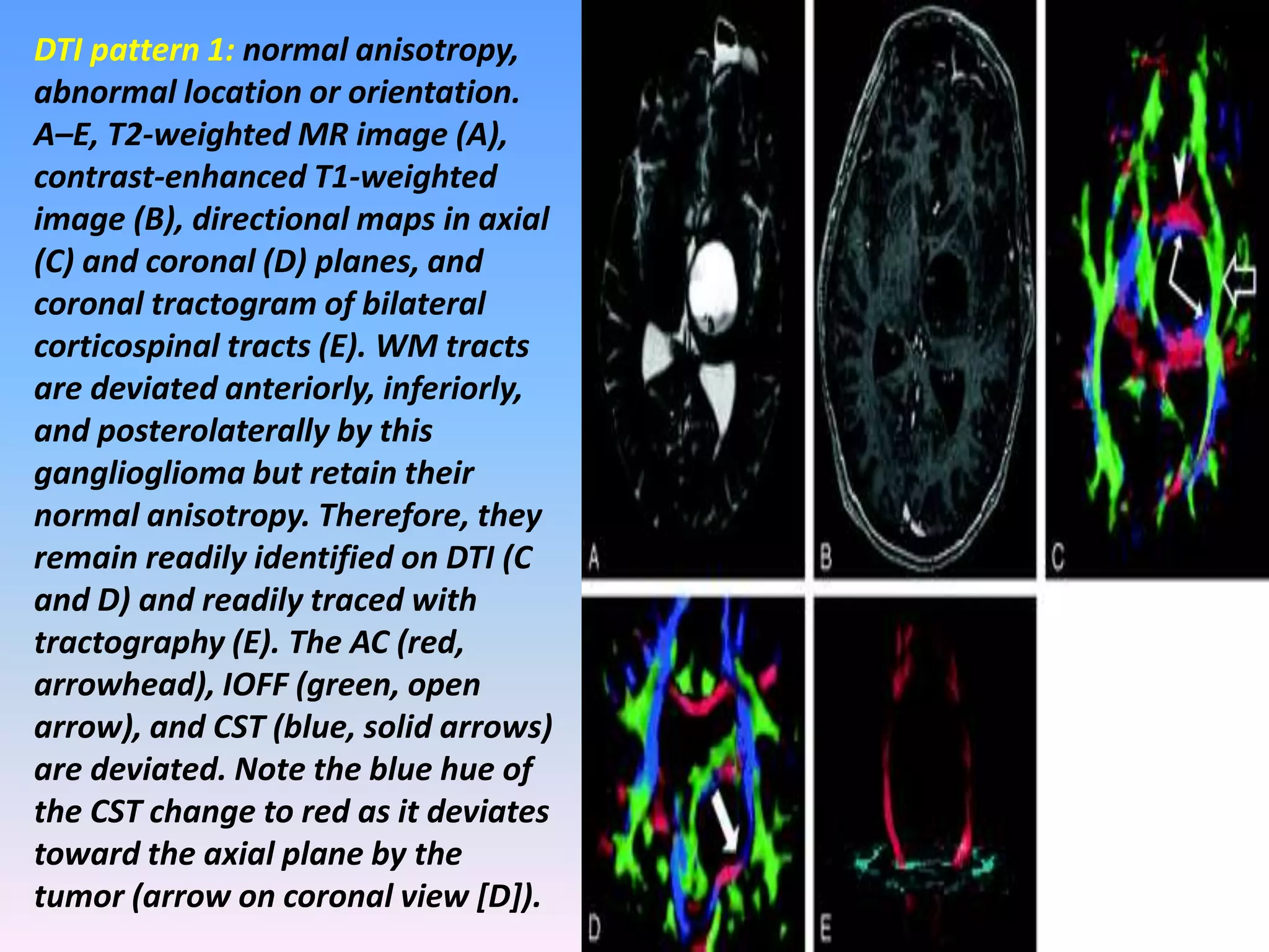 Presentation1.pptx, diffusion tensor imaging of white matter tract in ...