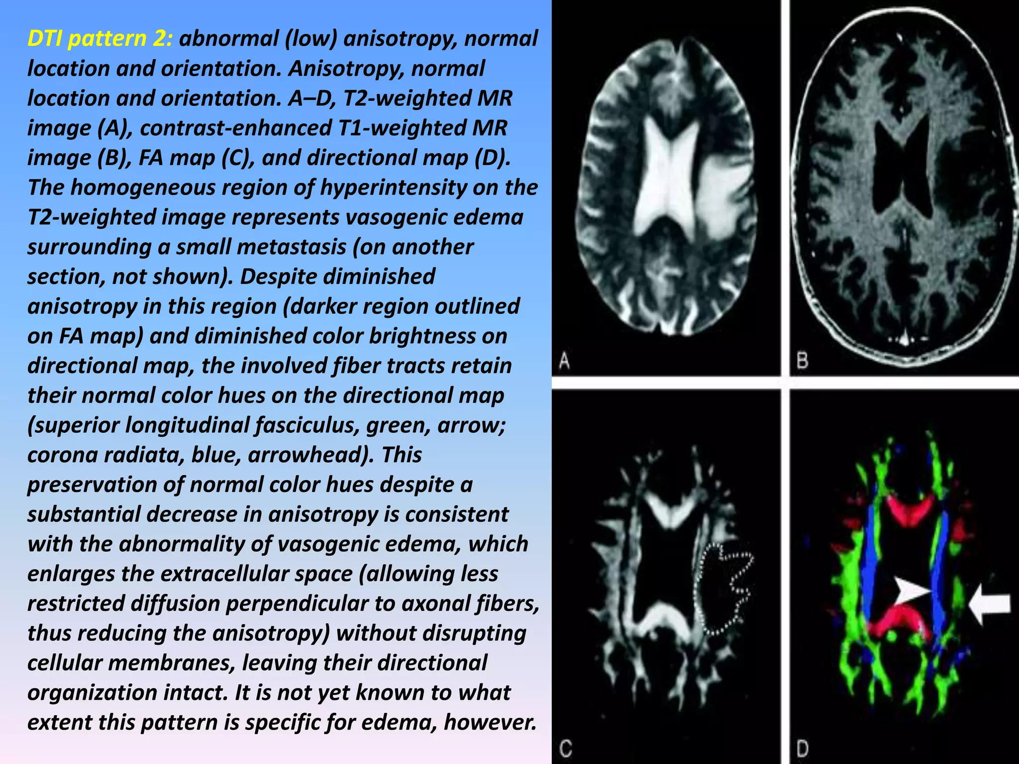 Presentation1.pptx, diffusion tensor imaging of white matter tract in ...