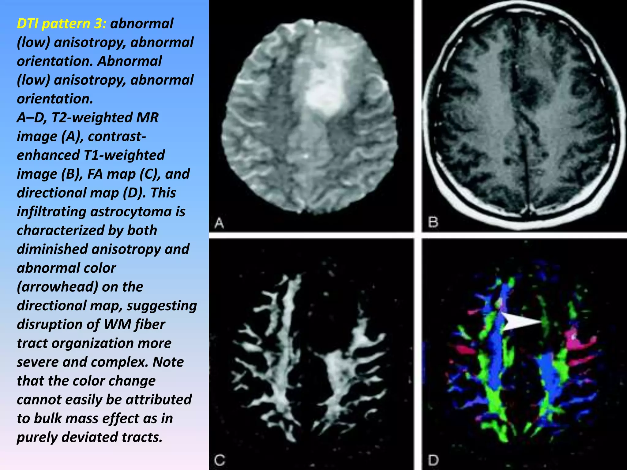 Presentation1.pptx, diffusion tensor imaging of white matter tract in ...