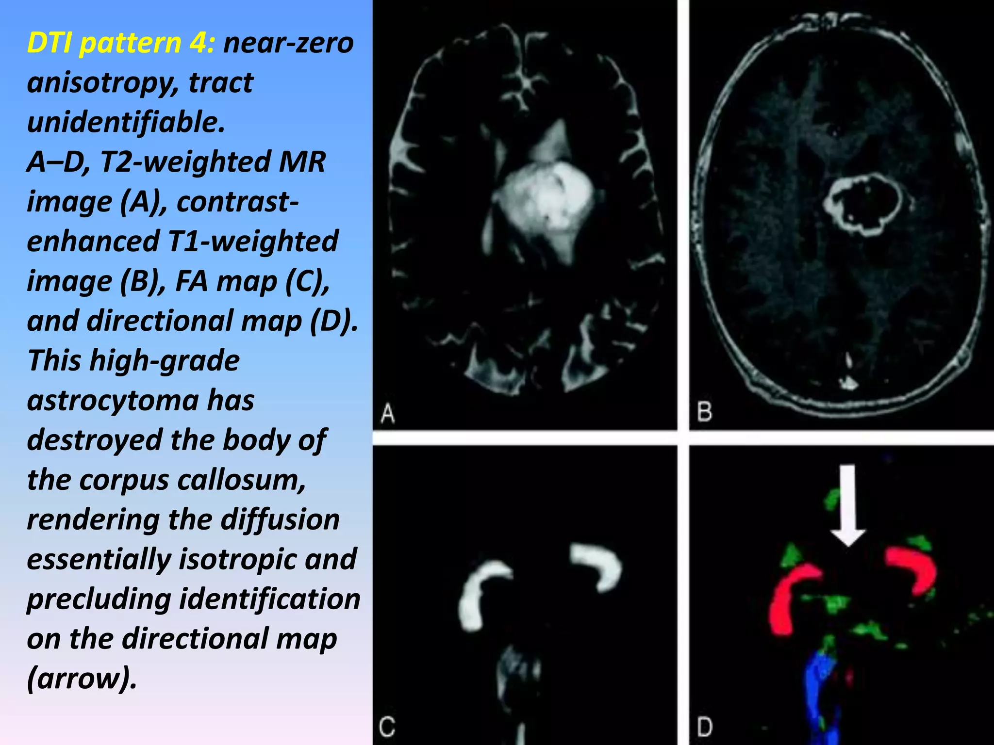 Presentation1.pptx, diffusion tensor imaging of white matter tract in ...
