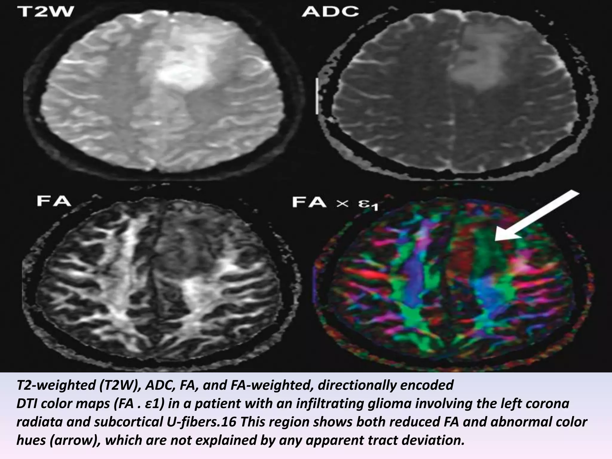 Presentation1.pptx, diffusion tensor imaging of white matter tract in ...