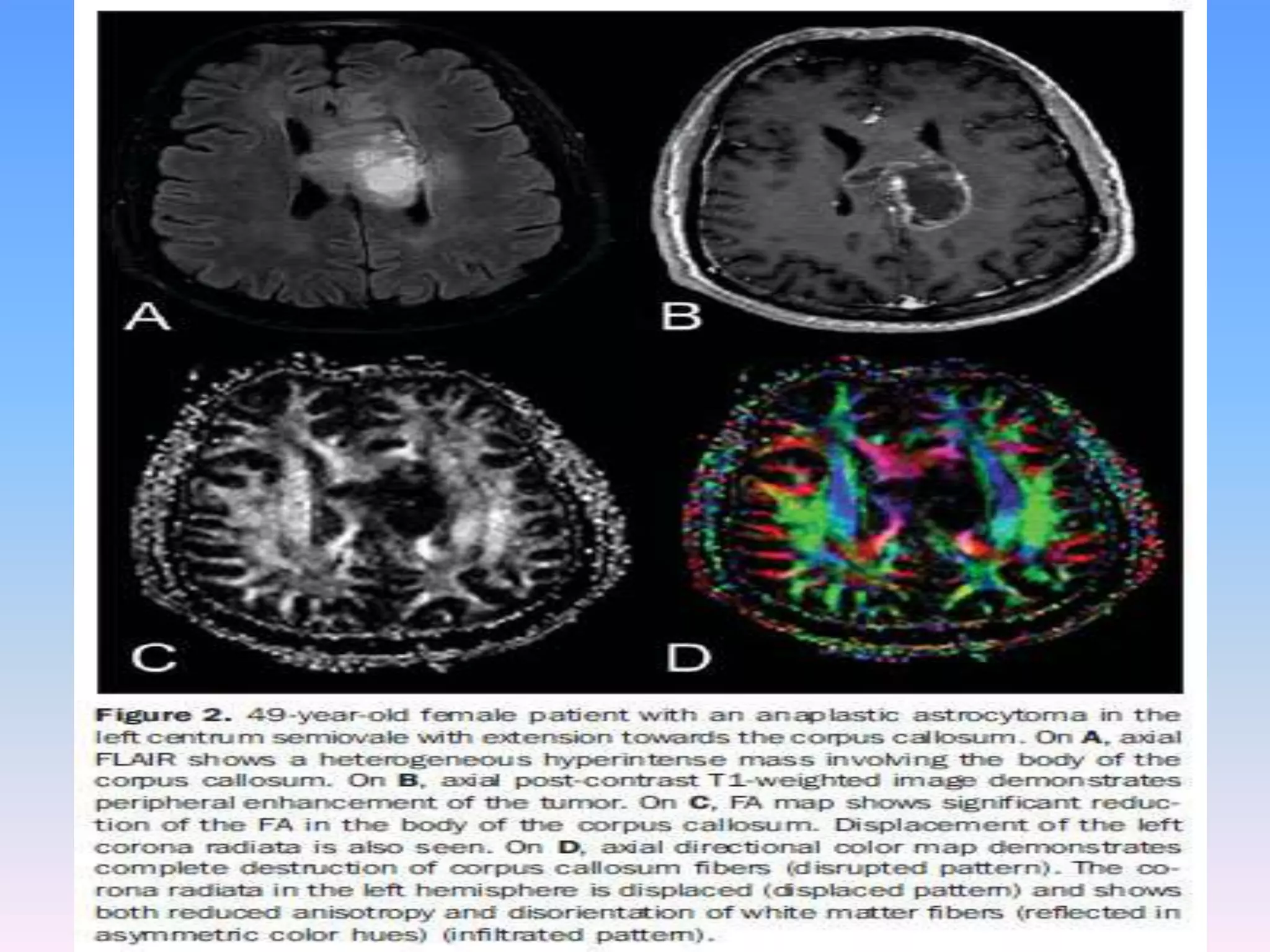 Presentation1.pptx, diffusion tensor imaging of white matter tract in ...
