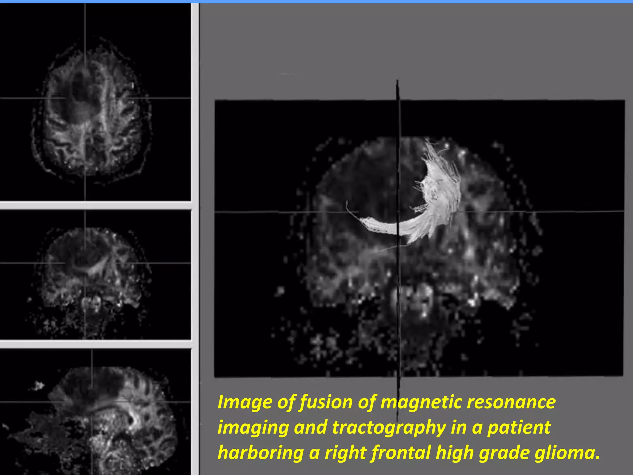 Presentation1.pptx, diffusion tensor imaging of white matter tract in ...