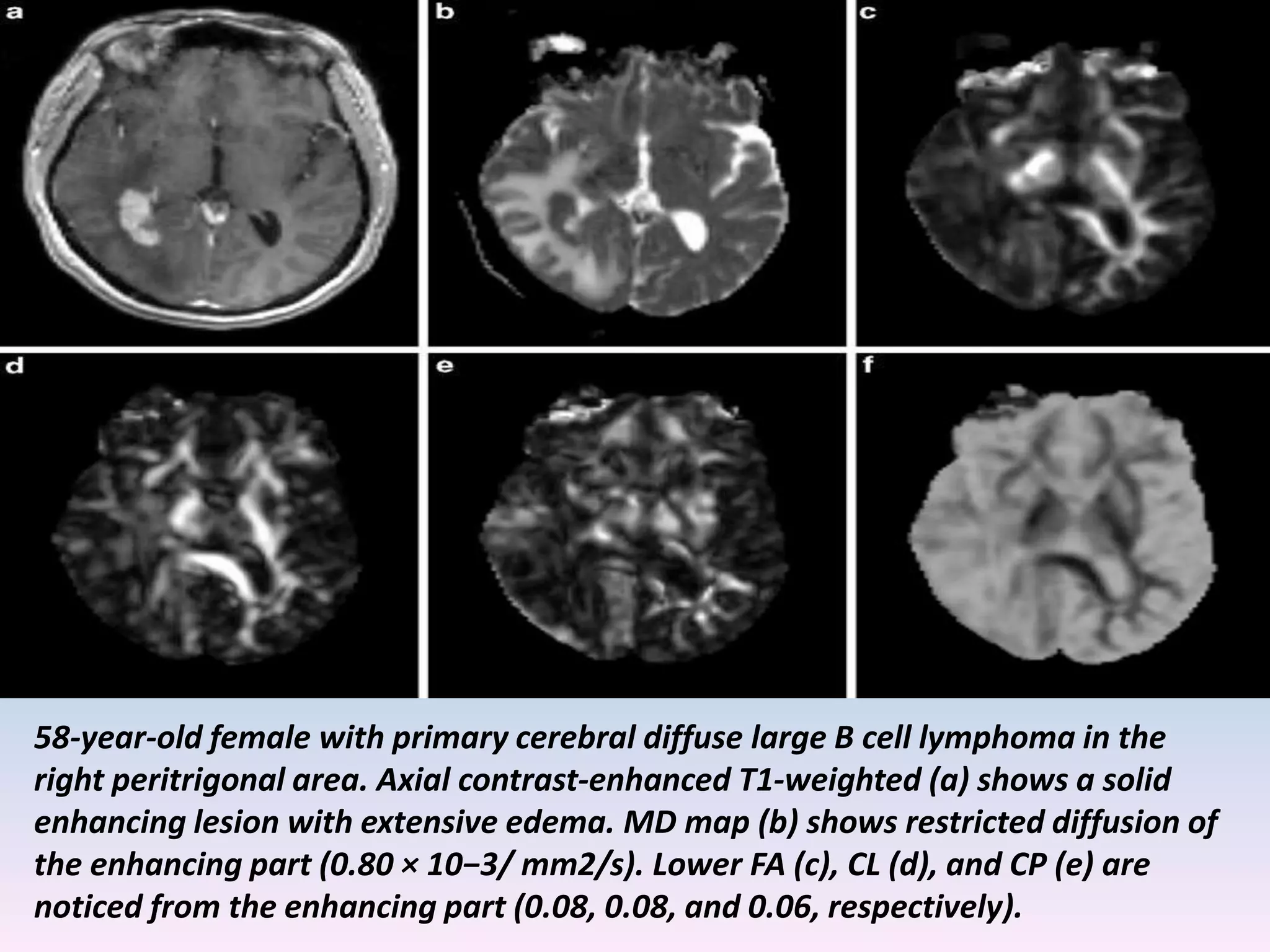 Presentation1.pptx, diffusion tensor imaging of white matter tract in ...