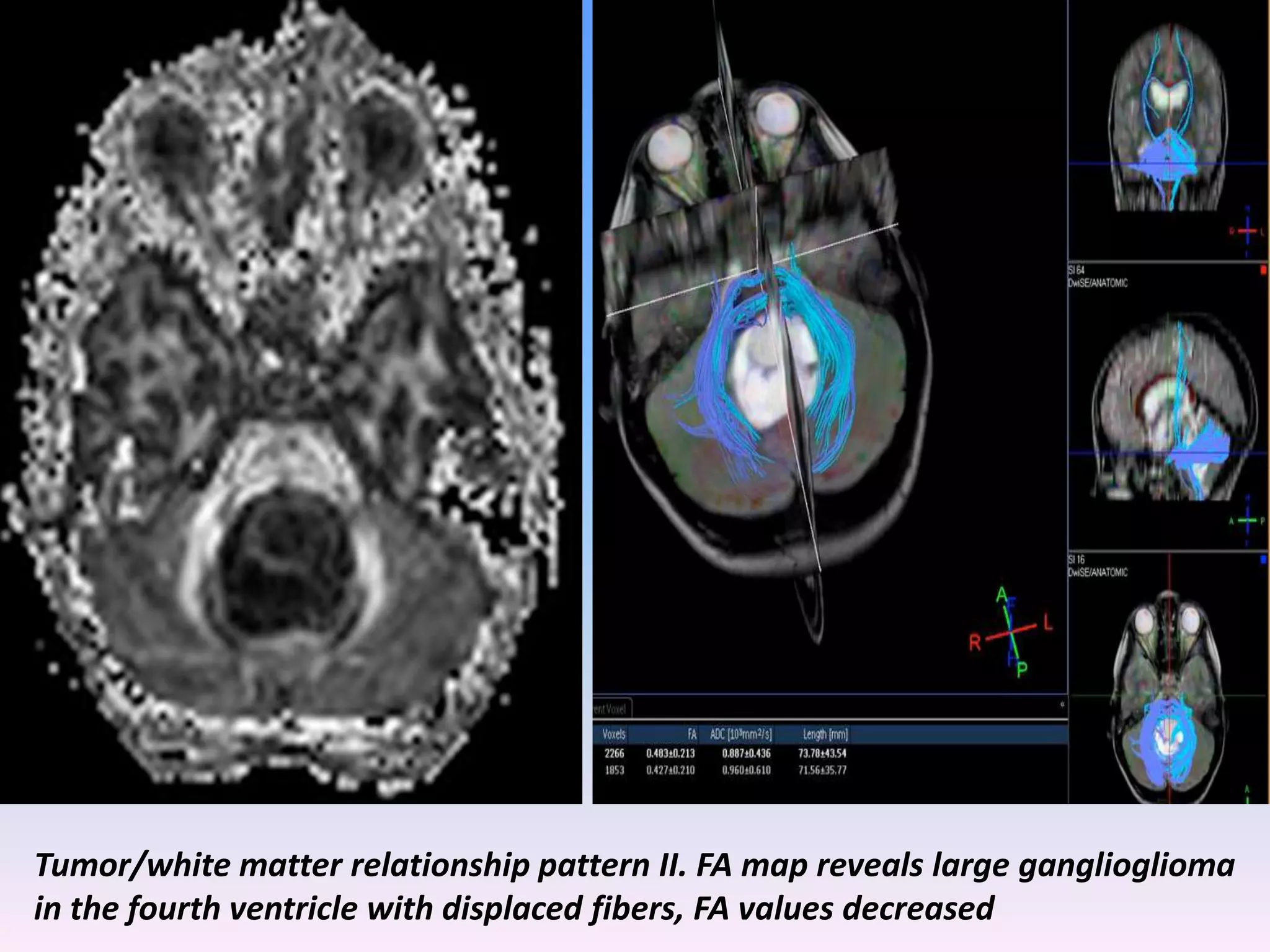 Presentation1.pptx, diffusion tensor imaging of white matter tract in ...