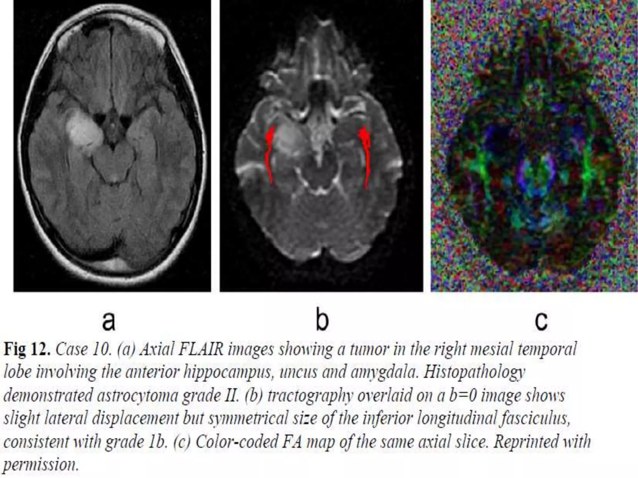 Presentation1.pptx, diffusion tensor imaging of white matter tract in ...