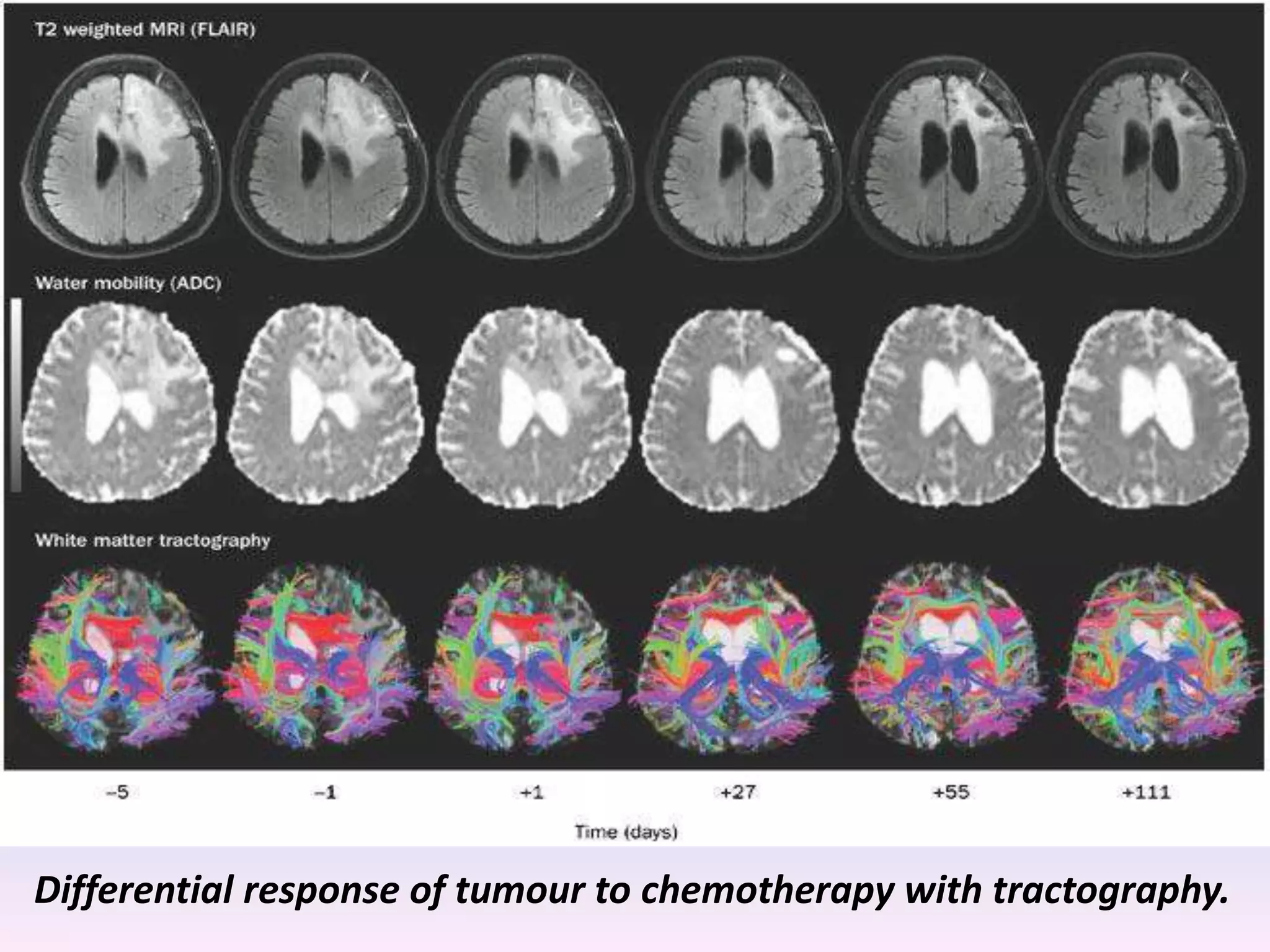 Presentation1.pptx, diffusion tensor imaging of white matter tract in ...