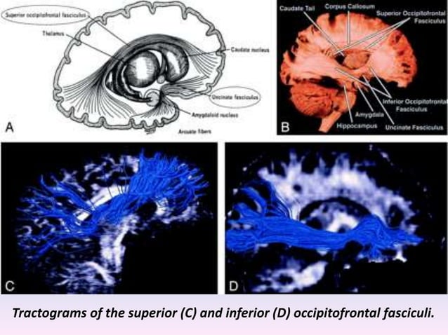 Presentation1.pptx, diffusion tensor imaging of white matter tract in ...
