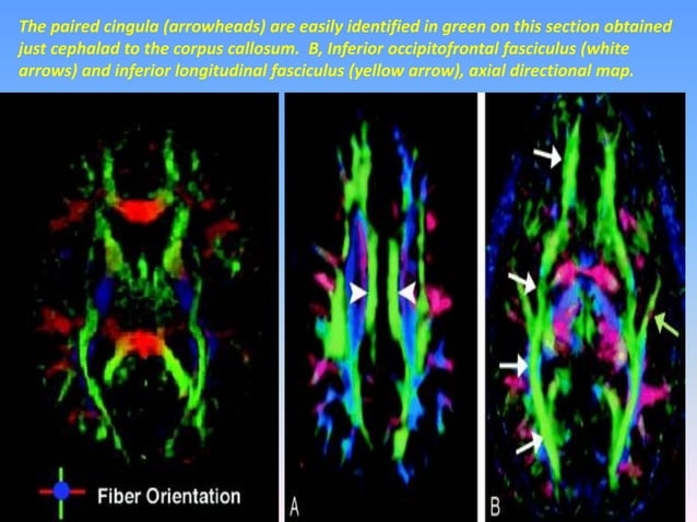 Presentation1.pptx, diffusion tensor imaging of white matter tract in ...